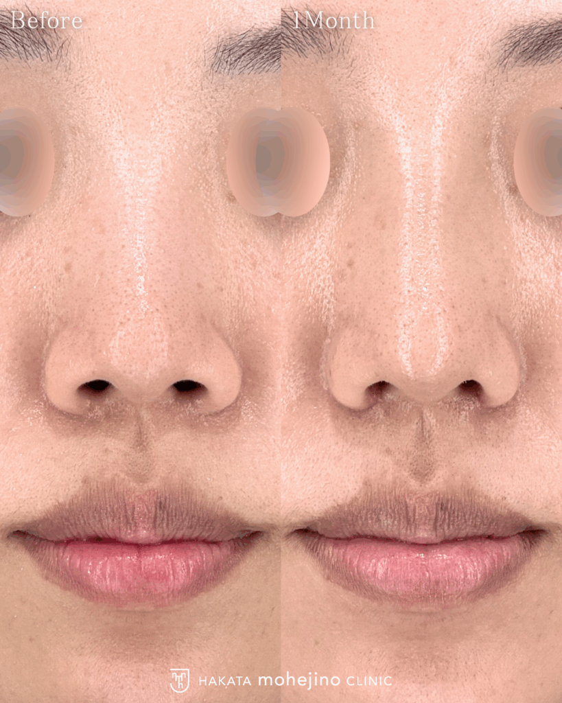鼻オーダーメイドプロテーゼ+小鼻縮小(内側法) | CASE | 博多もへじのクリニック